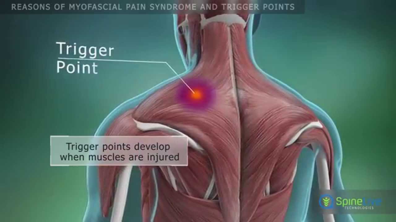 Myofascial pain syndrome and trigger points. Reasons