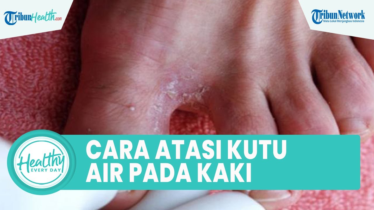 Kenali Gejala dan Cara Mengatasi Kutu Air pada Kaki, Memerah hingga ...