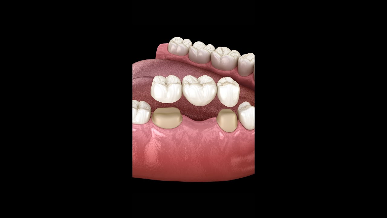 What is a dental bridge?