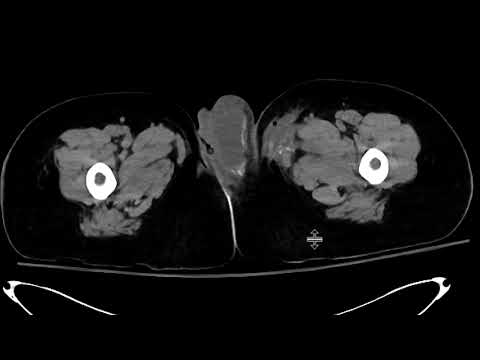 Extraperitoneal bladder rupture