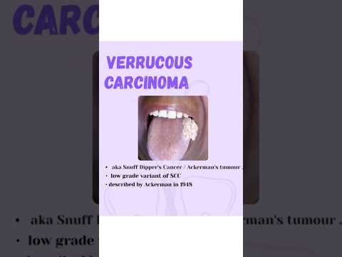 #oralpathology #bds #bds3rdyr #dental #dentalstudents #dentalnotes #verrucouscarcinoma #dentistry