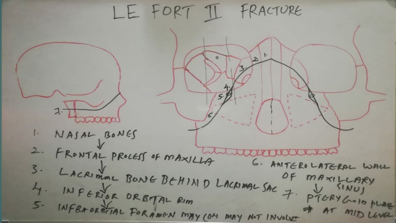 LE FORT-II FRACTURE LINE