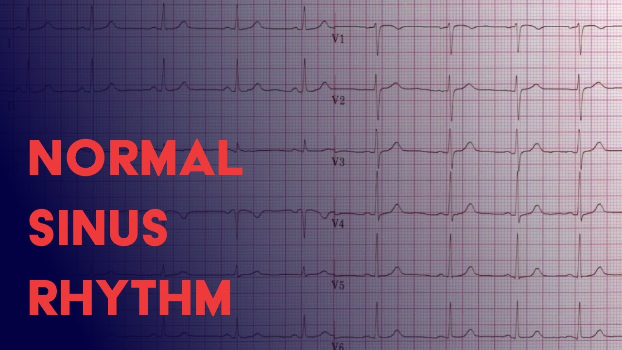 Normal Sinus Rhythm -  EKG (ECG) Interpretation
