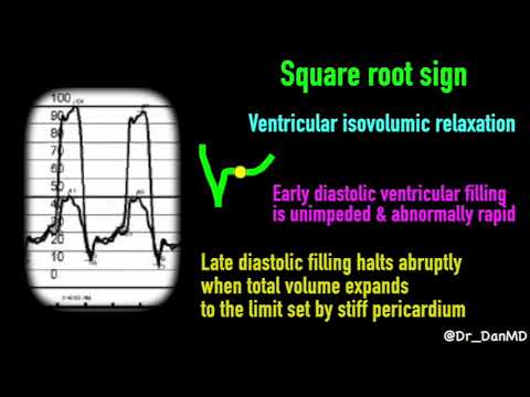 Constrictive pericarditis