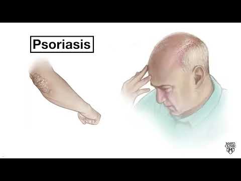 Mayo Clinic Minute - Psoriasis of the scalp