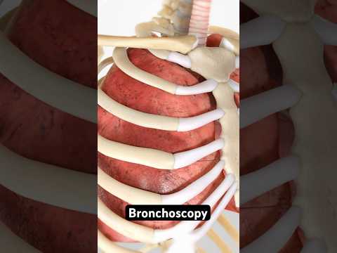What is Bronchoscopy? (3D Animation)