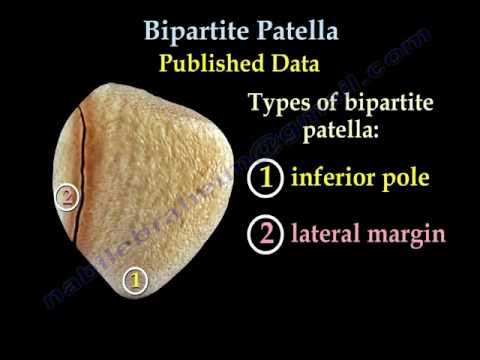 Bipartite Patella - Pediatrics - Orthobullets