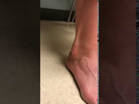 Dislocating Peroneal Tendons