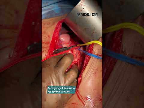 Emergency Splenectomy Hilum Control