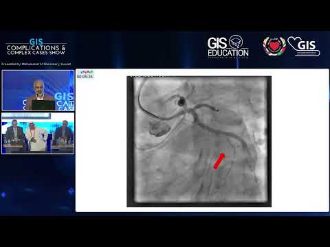 20 Mohammed Al Shemmery Distal Coronary Artery Perforation Management