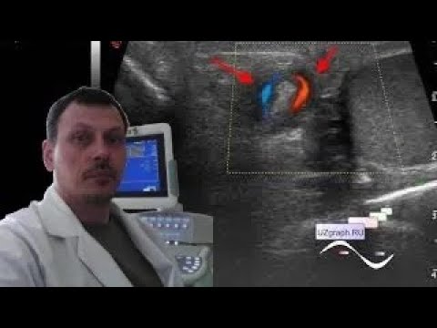 Pediatric Scrotal ultrasound - Torsion of the spermatic cord