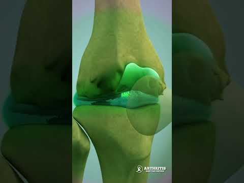 FDA Approved Gel, Visco -supplement Knee Injections Help You Avoid Surgery