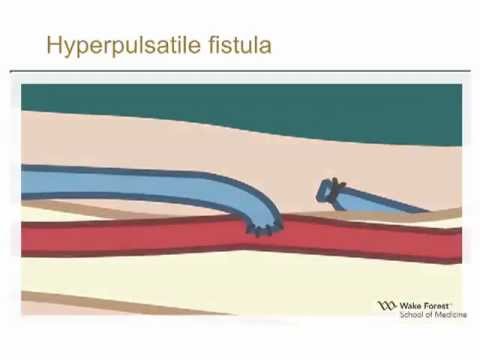 Arteriovenous Fistula (AV) « NephroCare Nursing