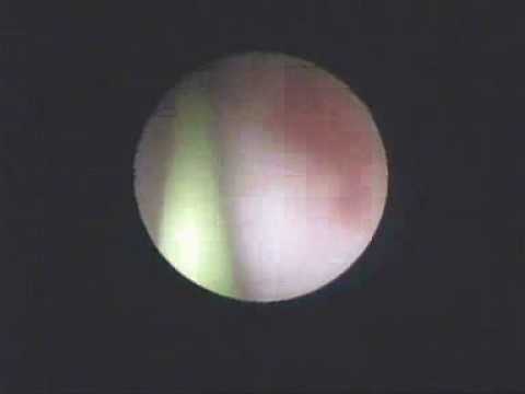 Ureterorenoscopy (URS) for large ureteric calculus