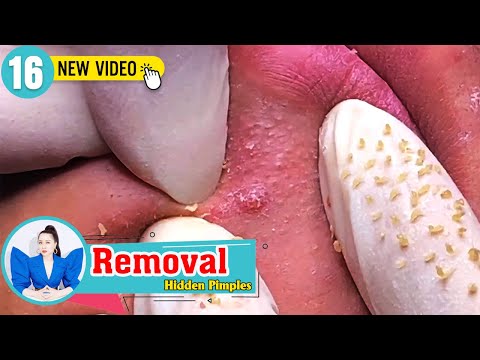 removal acne hidden under skin clients -  kim hang spa 16