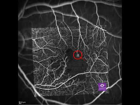 FFA and OCTA overlap of a retinal microaneurysm