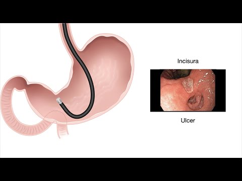 HCC 1475-4 - Stomach - Pathology Endoscopy Findings