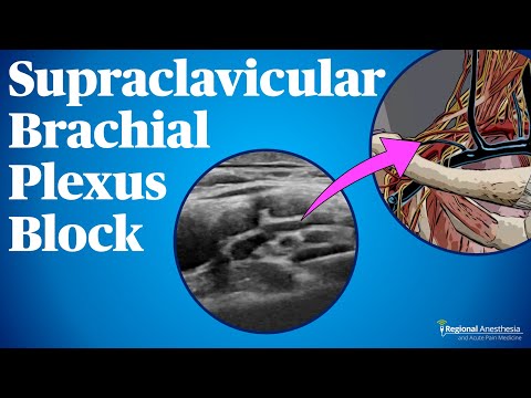 Supraclavicular Brachial Plexus Block