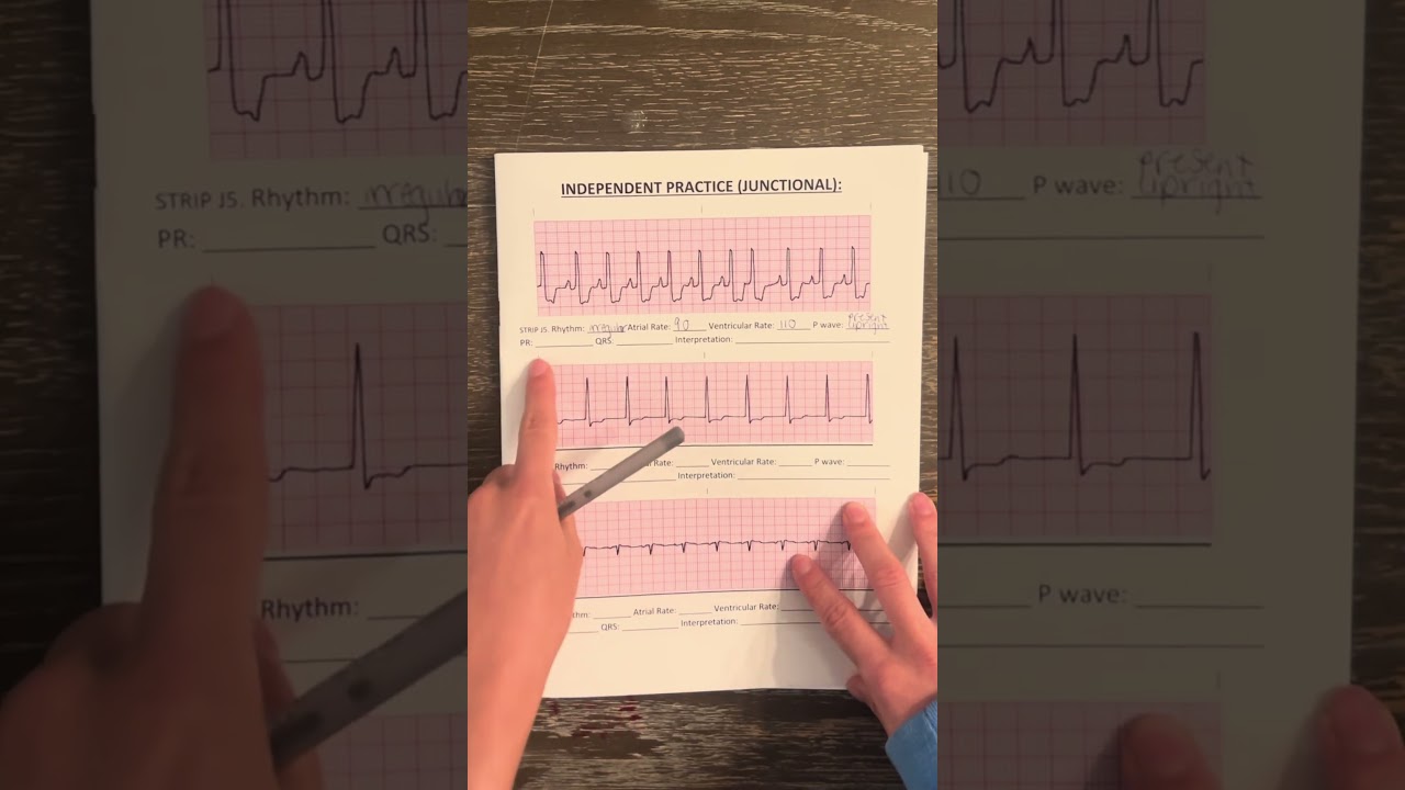 How to Identify a Premature Junctional Contraction (PJC)