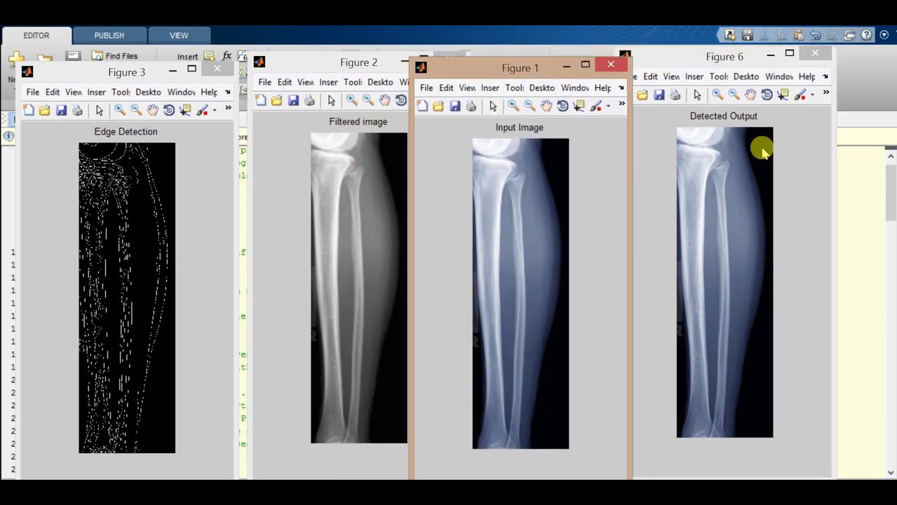 Bone Fracture Detection using Image Processing matlab Source code
