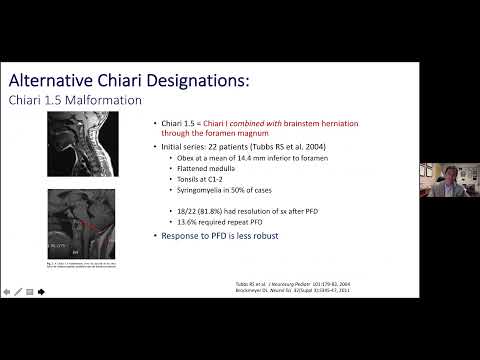 Chiari Type I Malformation: Never Simple, Often ‘Complex’