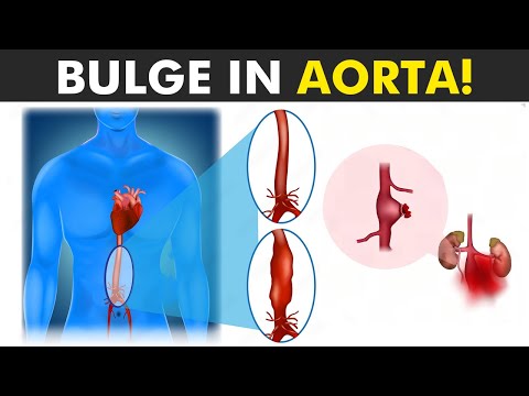 Aortic aneurysm: Causes, symptoms and Treatment
