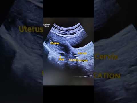 Pod collection with uterine calcification
