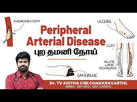 peripheral arterial disease treatment in Tamil ! Causes, symptoms, treatment of Pad!Doctoradithacibi