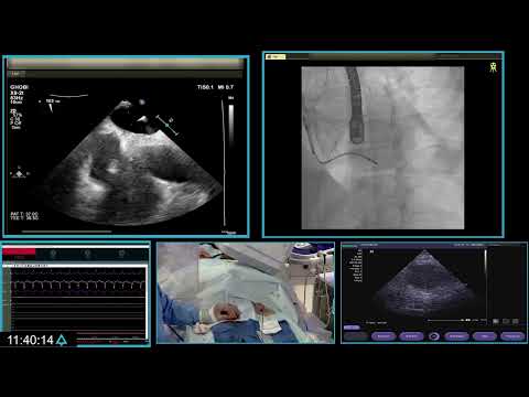 Watchman implant procedure!