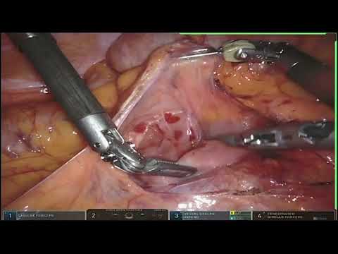 Fully Robotic Duodenojejunostomy for Superior Mesenteric Artery Syndrome