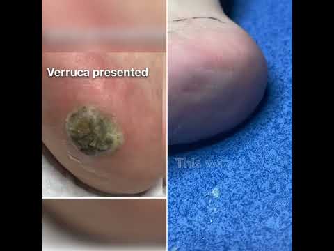 Verucca what treatment works?
