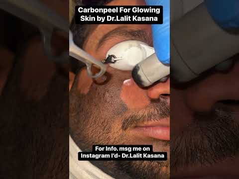 CARBON LASER PEEL Before and After Dr. Kasana's Clinic