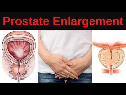 Enlarged Prostate Signs and Symptoms, Causes