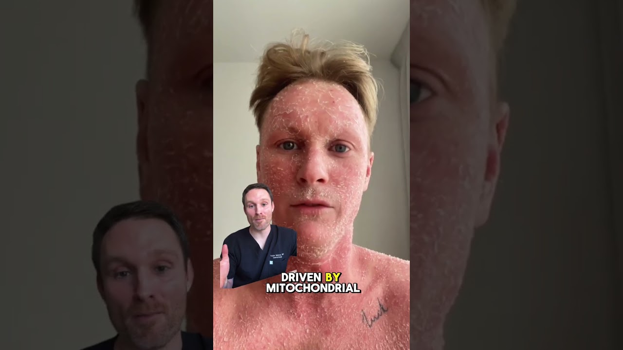 ⚠️POV: The steroids are no longer helping (topical steroid withdrawal -- TSW)