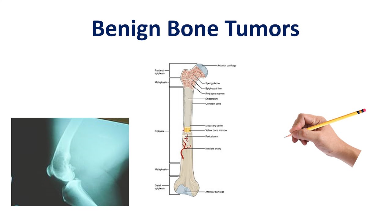 Benign Bone Tumors Made Simple