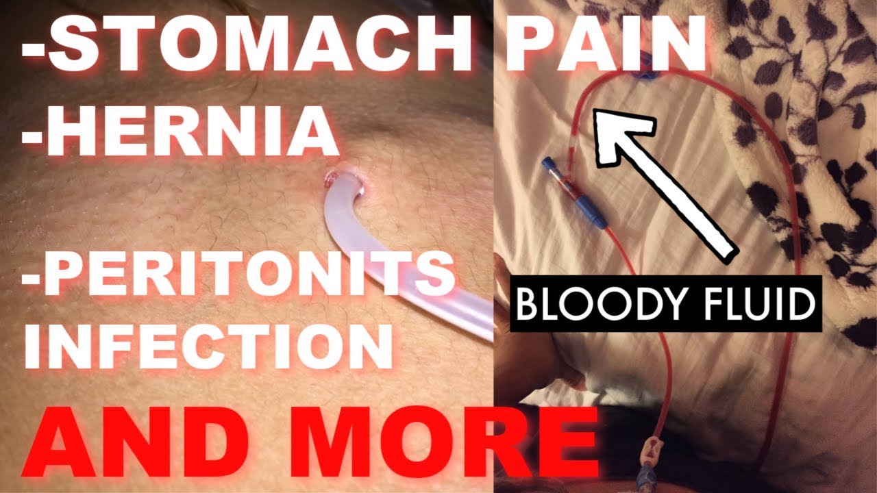 PROBLEMS I FACED DURING PERITONEAL DIALYSIS!!