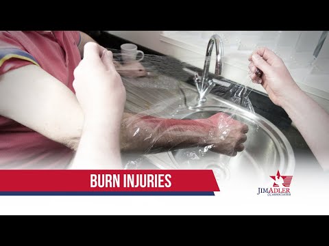 Burn Injuries | Jim Adler & Associates | Hammer TV