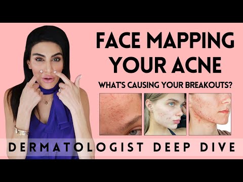 Face Mapping: What's Causing Breakouts Based on Acne Location | Dermatologist Deep Dive