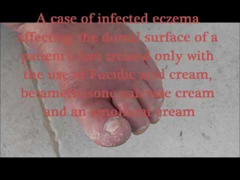 A case of infected foot eczema treated only with creams