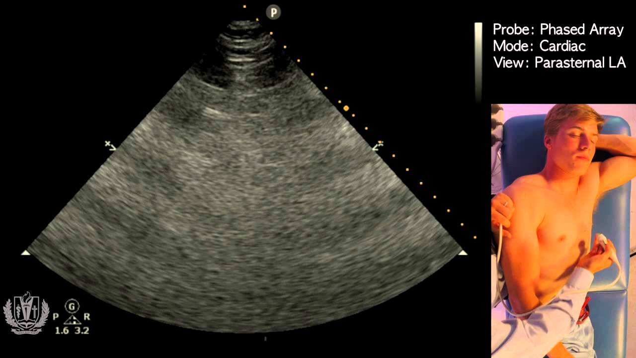 Parasternal Long Axis View - STEP by STEP Point of Care Ultrasound
