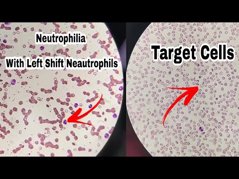 CBC Morphology | Target Cells |Neutrophilia With Left Shift Neutrophils