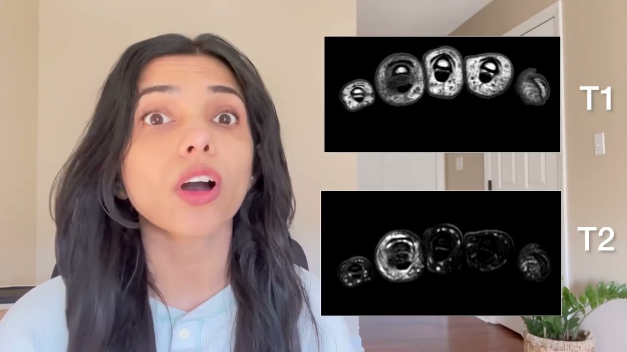 Don’t miss Pseudogout on X-ray or MRI!
