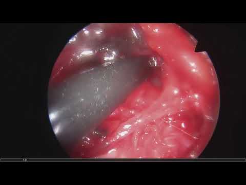 Video-assisted mediastinoscopic lymphadenectomy(VAMLA)