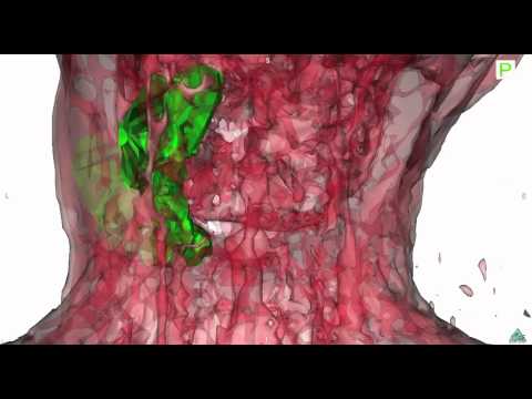Head & neck cancer - 3D MRI