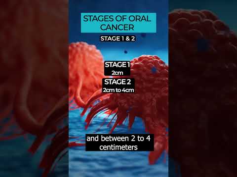 Understanding the Stages of Oral Cancer: Diagnosis and Treatment 🎗️👄 #OralCancer #cancerstages