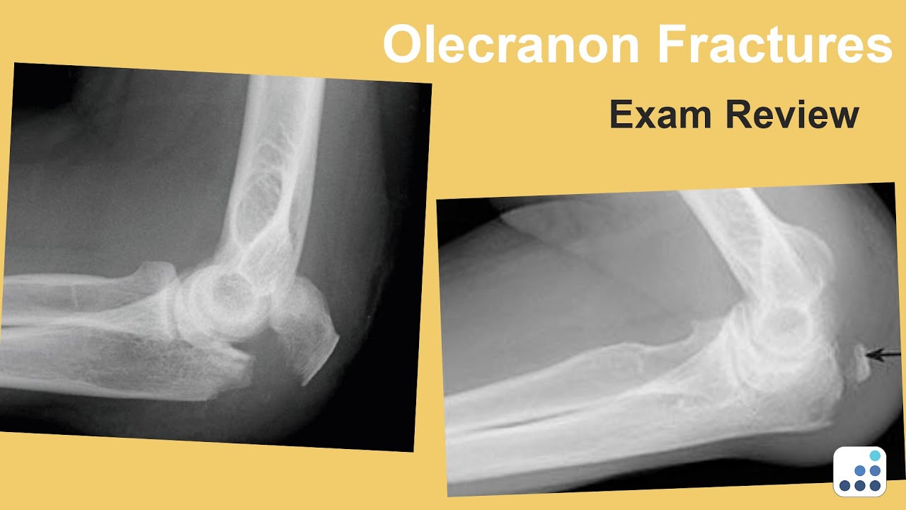 Olecranon Fractures - Joaquin Sanchez-Sotelo, MD