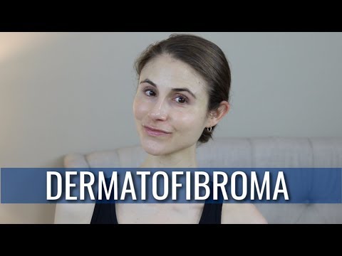 DERMATOFIBROMA: WHAT IS IT? HOW IS IT TREATED? | DR DRAY