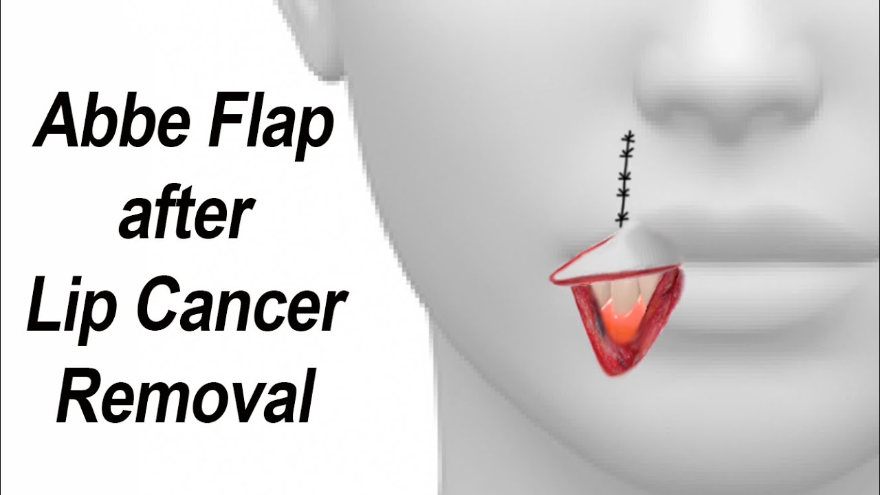 Lip Cancer Removal with Abbe Flap Reconstruction