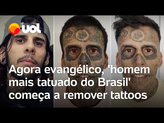 'Mais tatuado do Brasil' passa por sessões de remoção; veja resultado