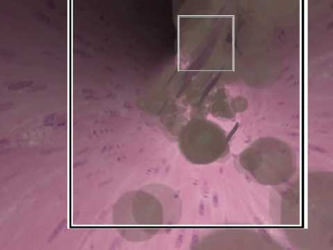Intravenous Leiomyomatosis